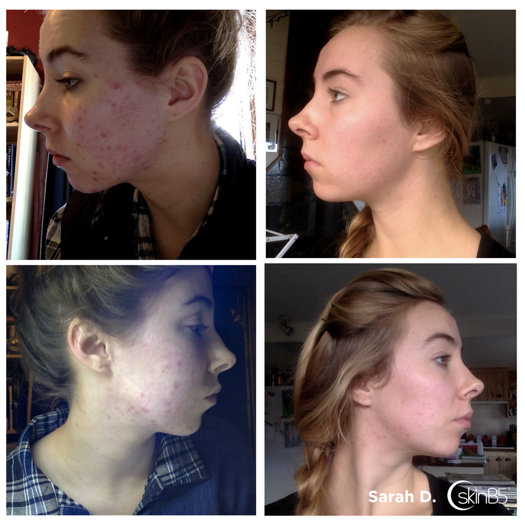 SkinB5 helped Sarah Downes to clear up her hormonal acne | SkinB5 ...