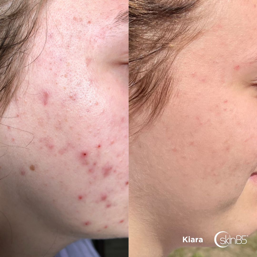 Kiara noticed her skin has changed in ONE week | SkinB5™ Official Site (HQ)