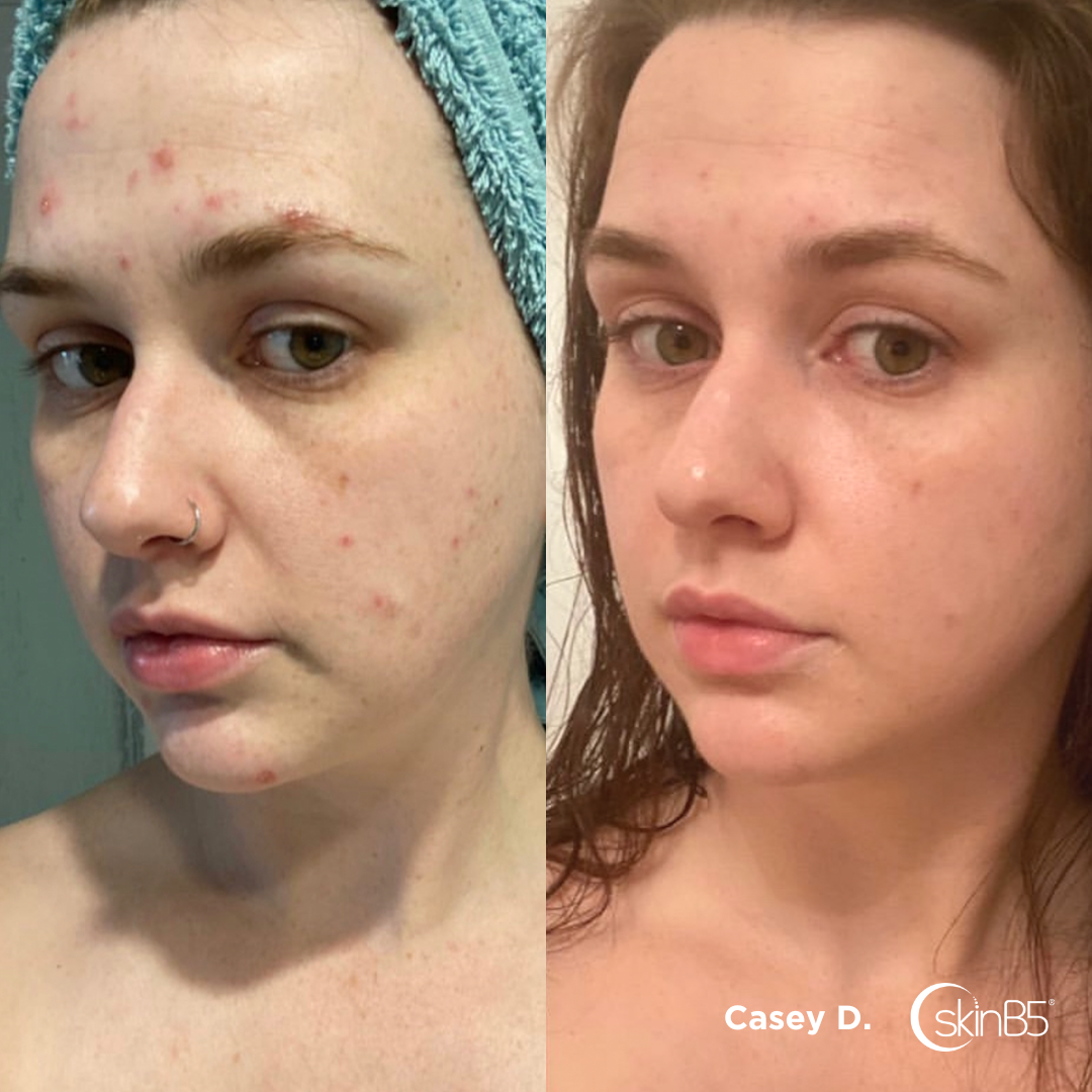 How Casey Davis completely cleared up her acne within 2 weeks | SkinB5 ...
