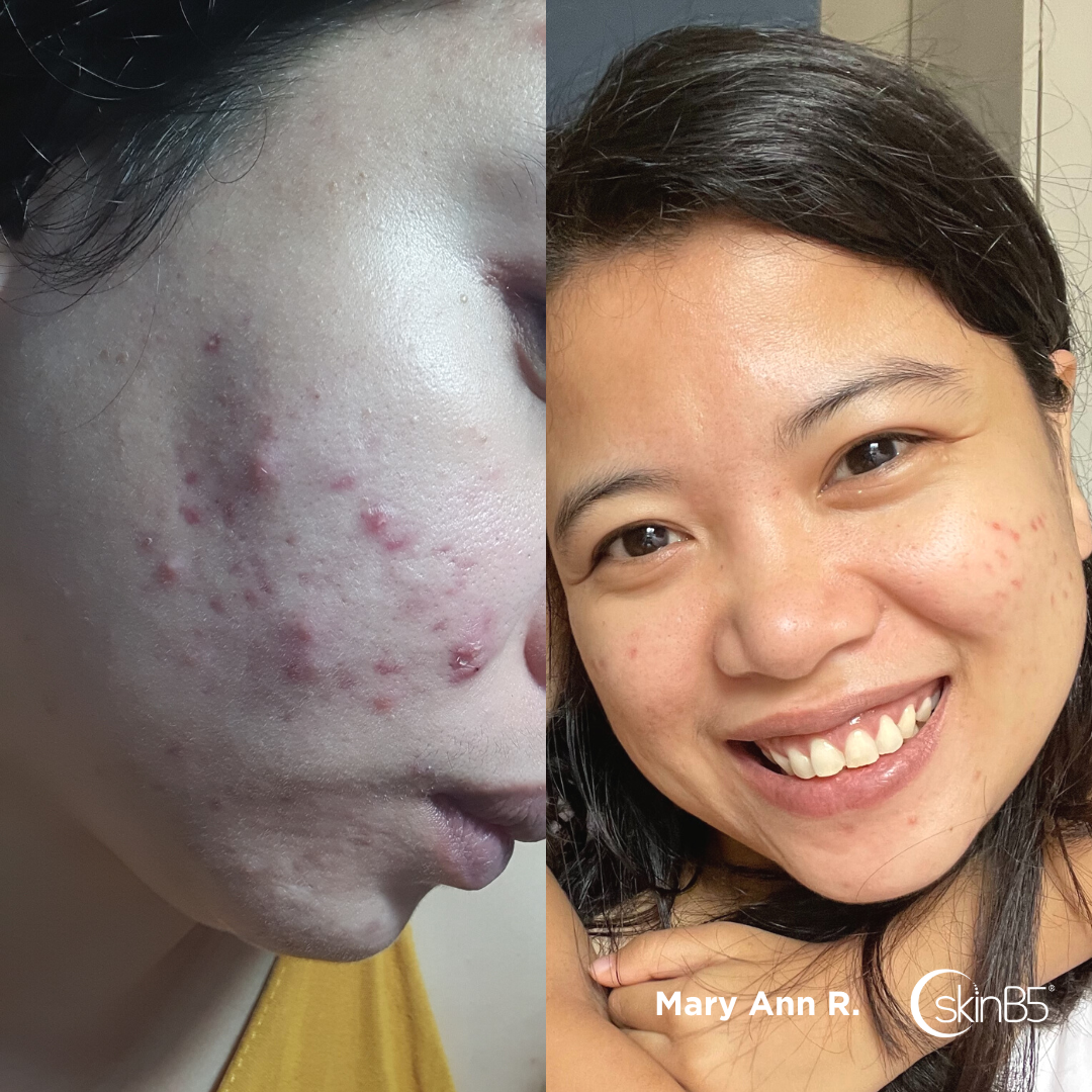 SkinB5™ helped Mary Ann Reyes to get rid of her severe acne | SkinB5 ...