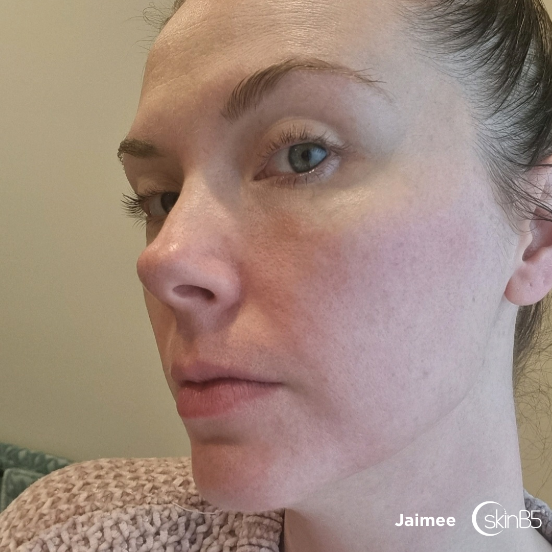SkinB5™ helped Jaimee Completely cleared up her acne in 2 weeks ...