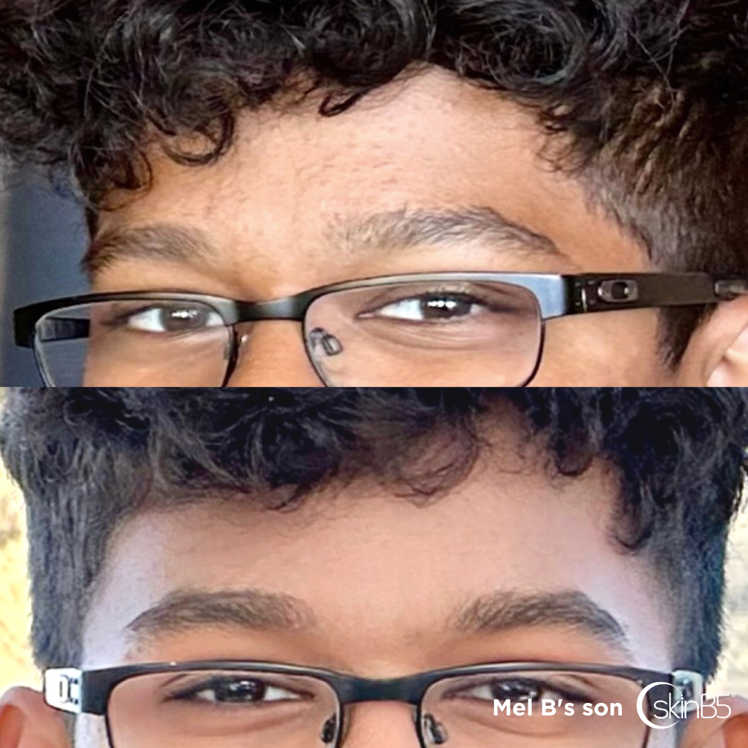 SkinB5™ helped Mel B's son cleared up his stubborn acne on forehead ...