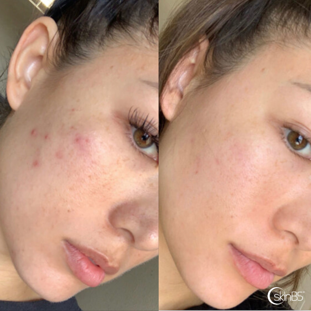 Persistent Breakouts Kit | Default Title | SkinB5™ Official Site (HQ)