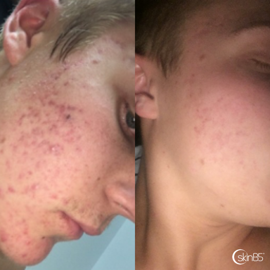 SkinB5 Starter Kit (FREE Bonus Mask) | SkinB5™ Official Site (HQ)